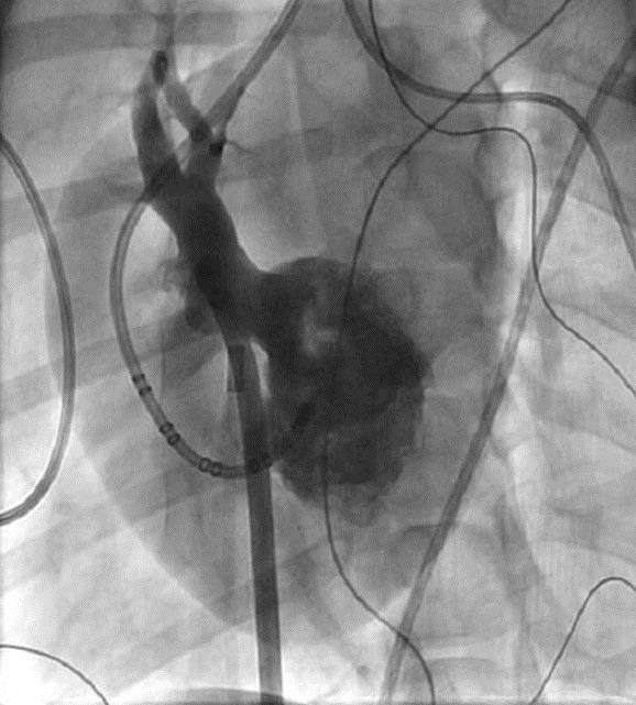 The Promise of Pulsed Field Ablation and the Critical Role of ...